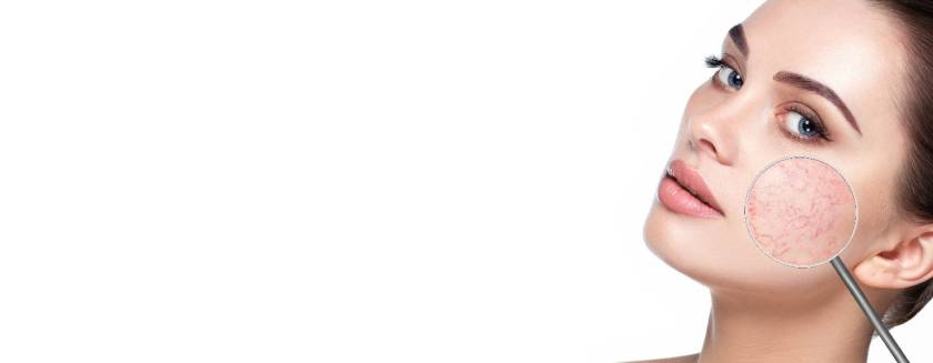 Laser Spider Veins Removal | Crystal Care Clinic