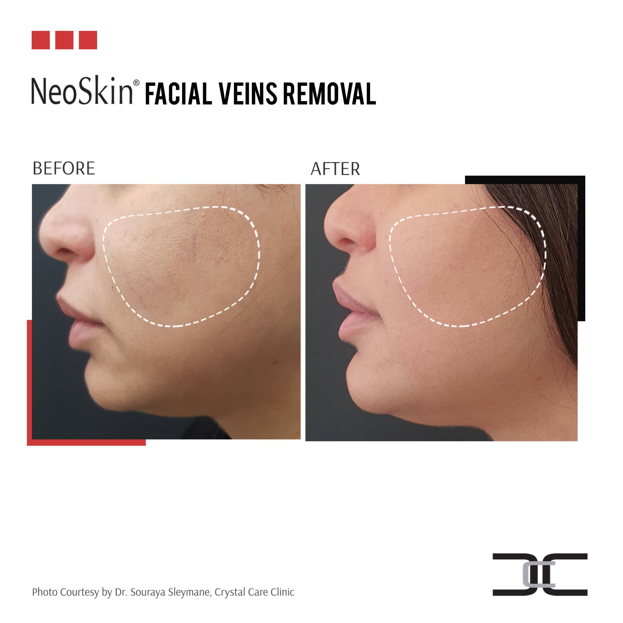 Laser Spider Veins Removal | Crystal Care Clinic