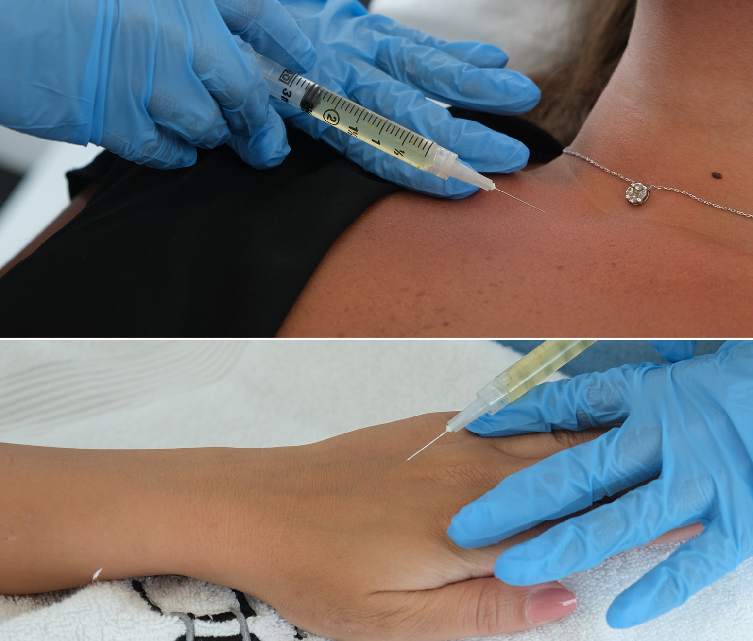 Prp treatment for face - Crystal Care Clinic