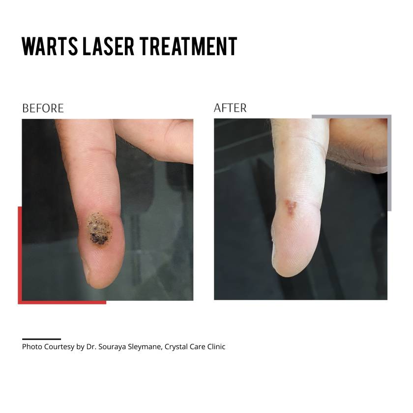 Laser Warts Treatment | Crystal Care Clinic