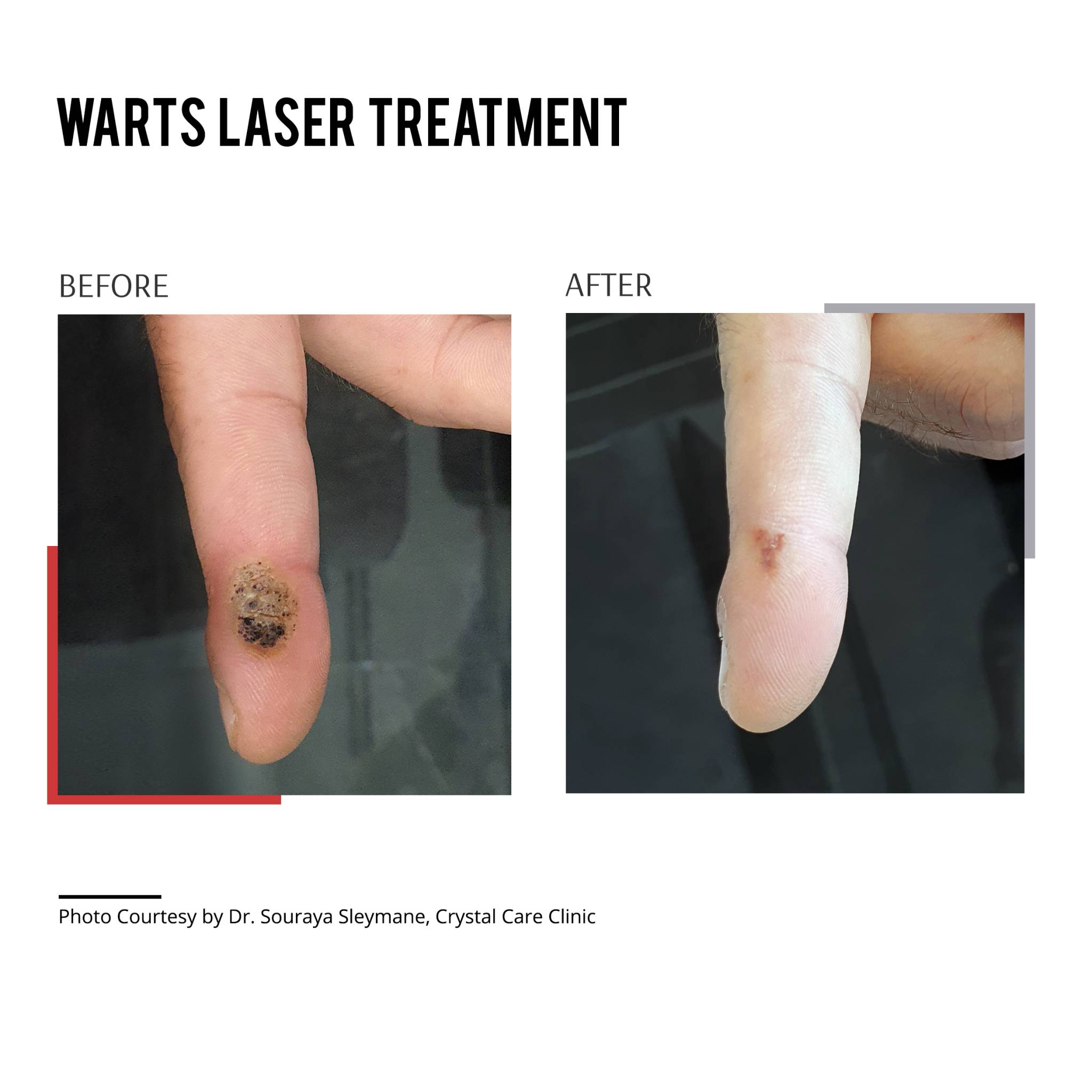 Laser Warts Treatment | Crystal Care Clinic