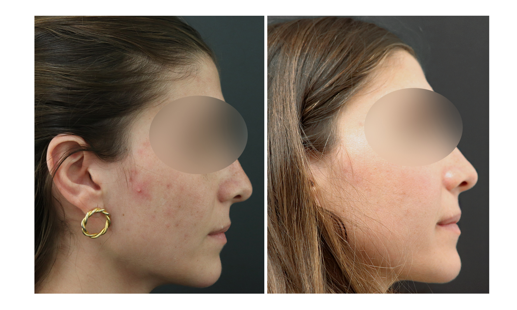 Laser Acne Scars Removal | Crystal Care Clinic