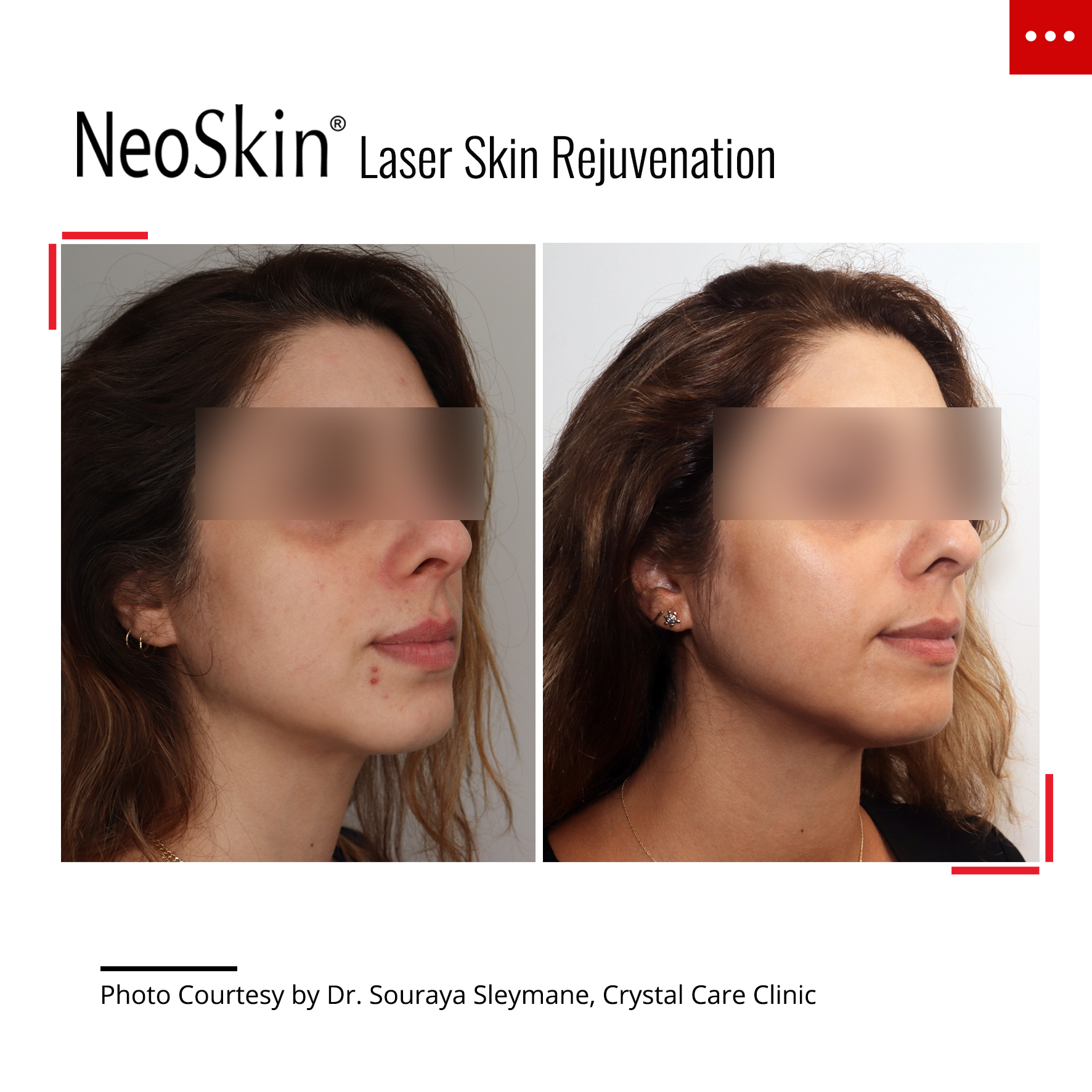 Laser Skin Rejuvenation | Crystal Care Clinic