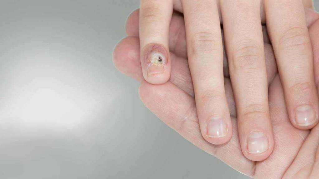 Laser Warts Treatment | Crystal Care Clinic